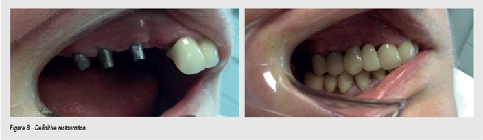 Unconventional Implant Placement Through Impacted Maxillary Canine – A ...