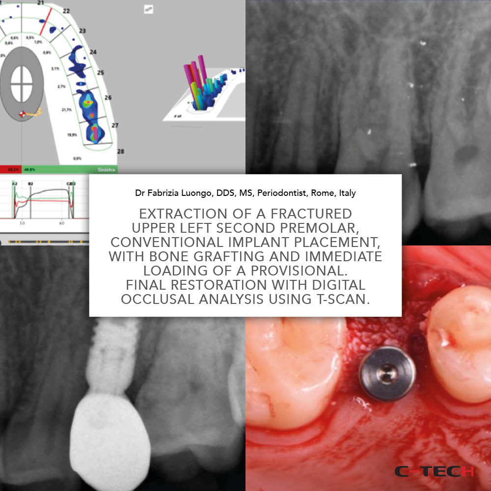 Extraction of a Fractured Upper Left Second Premolar, Conventional ...