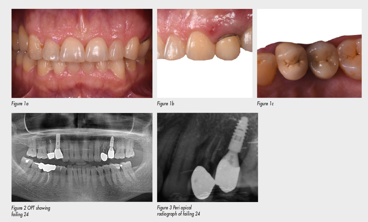 Extraction and immediate placement of a C-Tech Esthetic Line implant