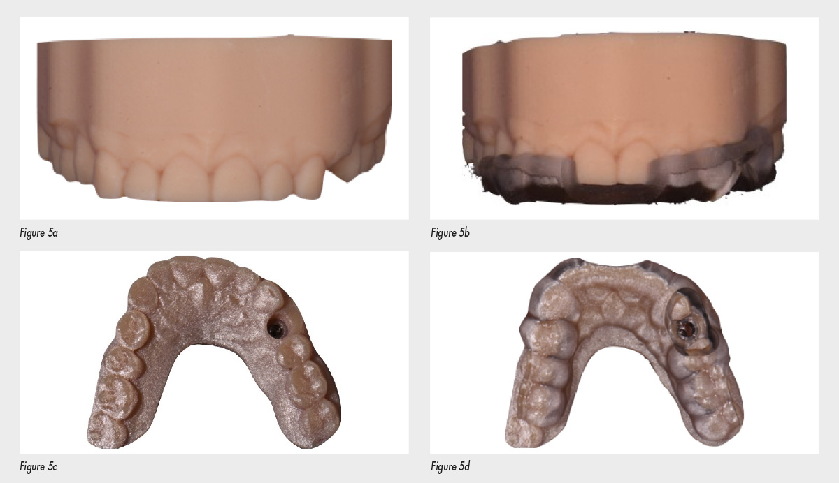 Extraction and immediate placement of a C-Tech Esthetic Line implant