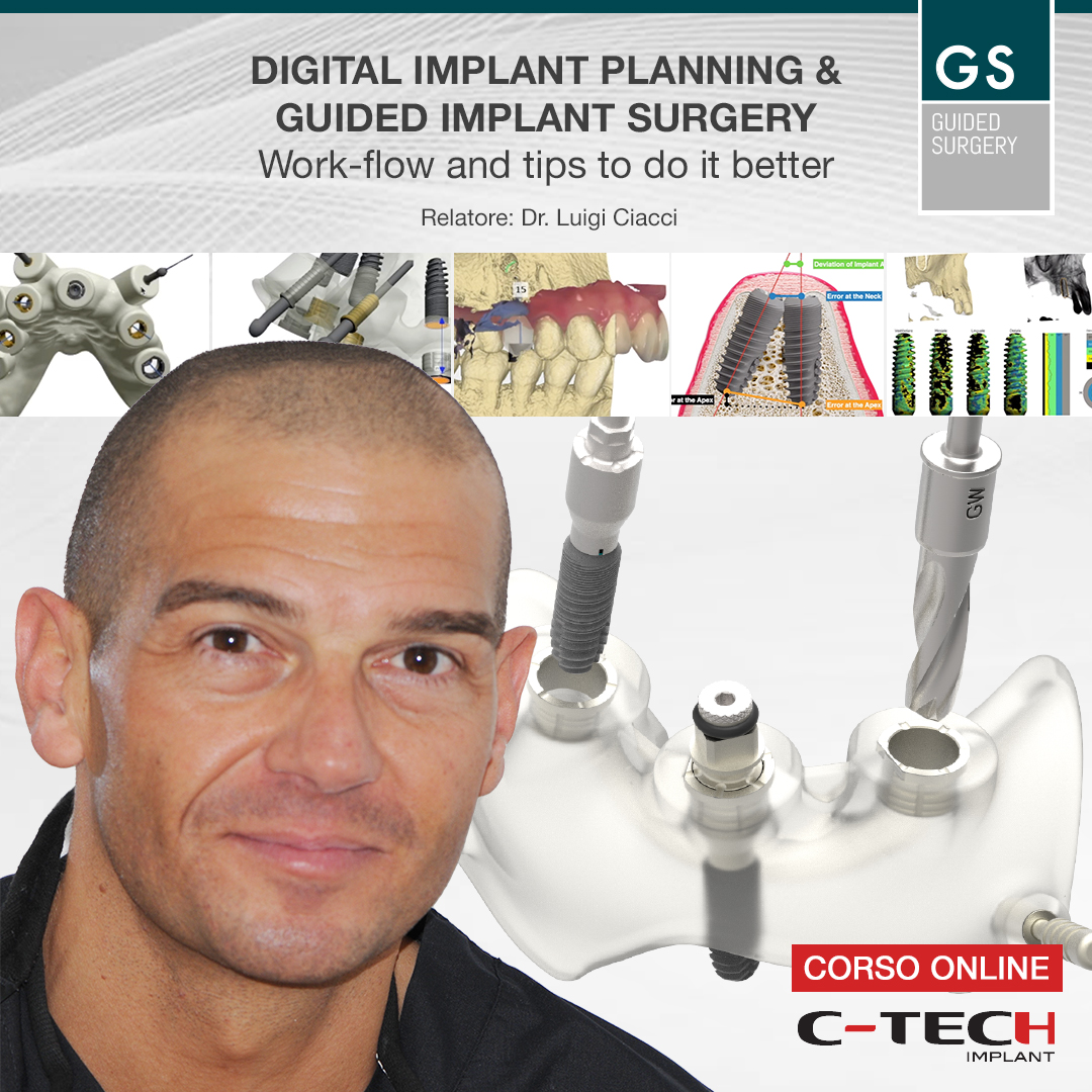 Guided Surgery Webinar | Digital implant planning: workflow and ...