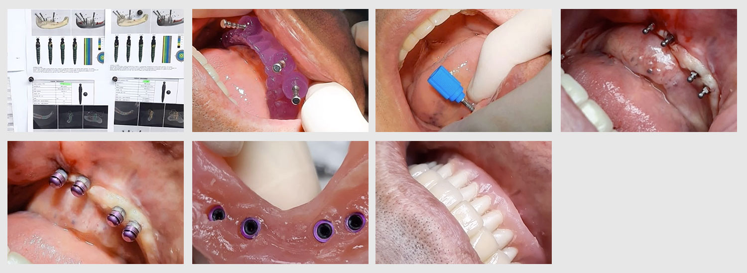 Mini Implant Guided Surgery, Full edentulous mandible prosthesis ...