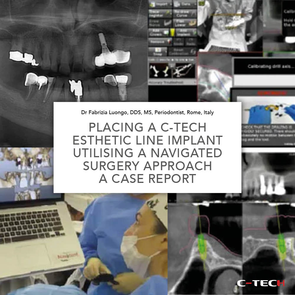 Placing a C-Tech Esthetic Line Implant witha Navigated Surgery Approach