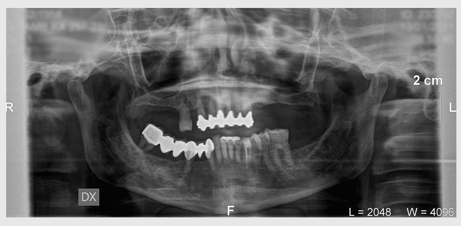 Upper arch rehabilitation | Dental implants EL Esthetic Line | C-Tech ...