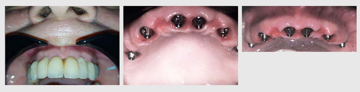 Upper arch rehabilitation | Dental implants EL Esthetic Line | C-Tech ...