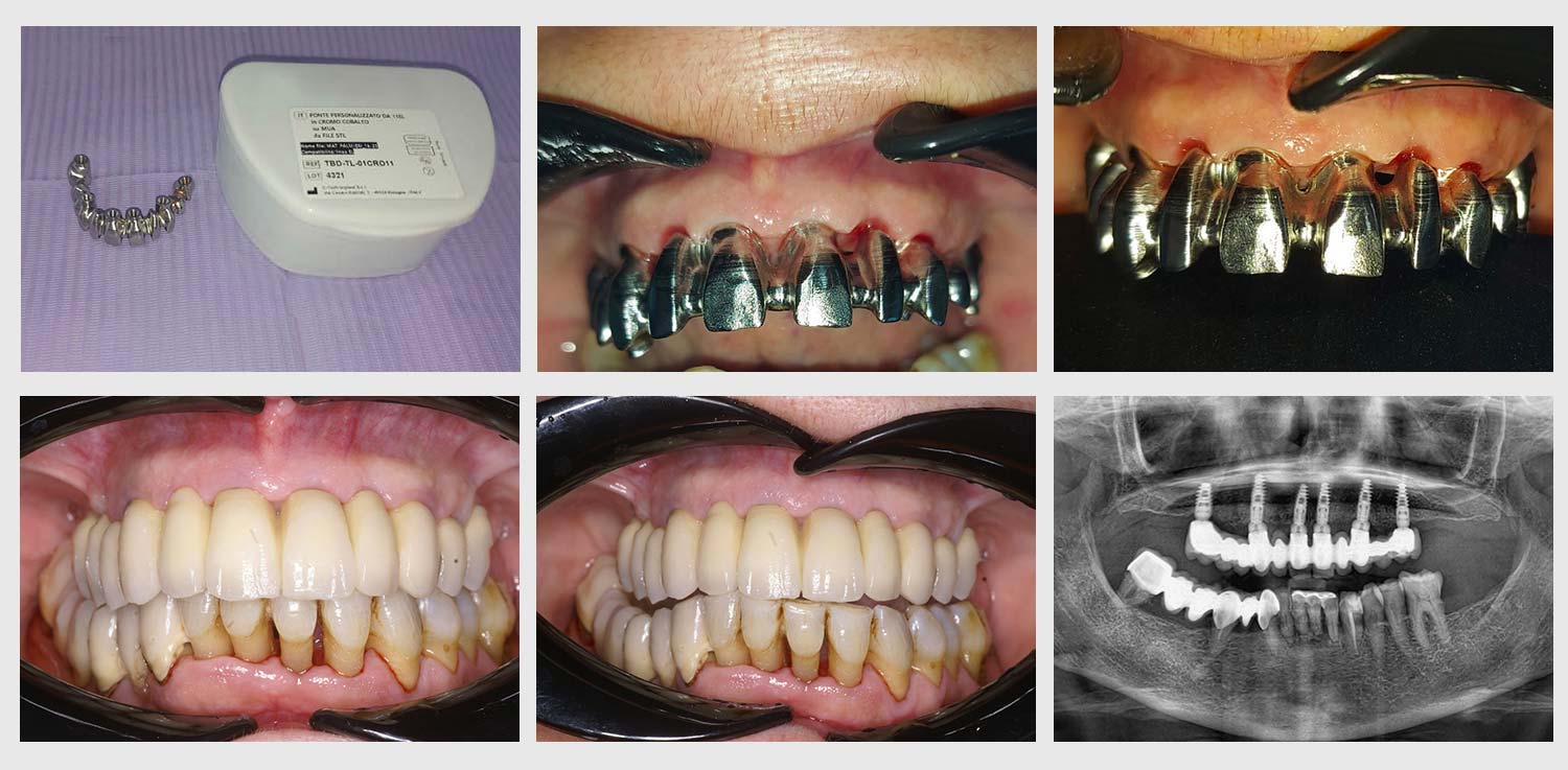 Upper arch rehabilitation | Dental implants EL Esthetic Line | C-Tech ...