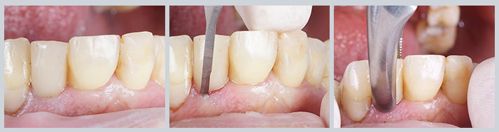 Immediate dental implant placement & immediate aesthetics on a upper ...