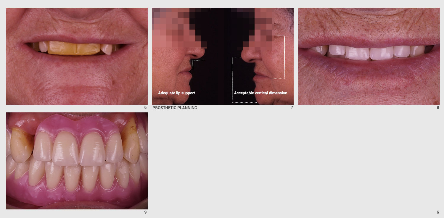 Full arch rehabilitation: Digital guided surgery for upper loading and ...