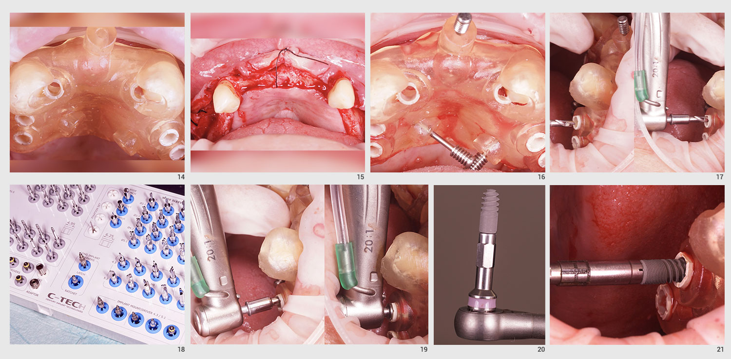 Full arch rehabilitation: Digital guided surgery for upper loading and ...