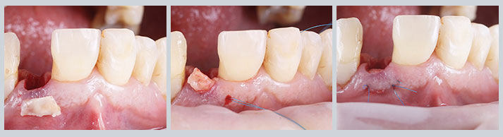 Immediate dental implant placement & immediate aesthetics on a upper ...