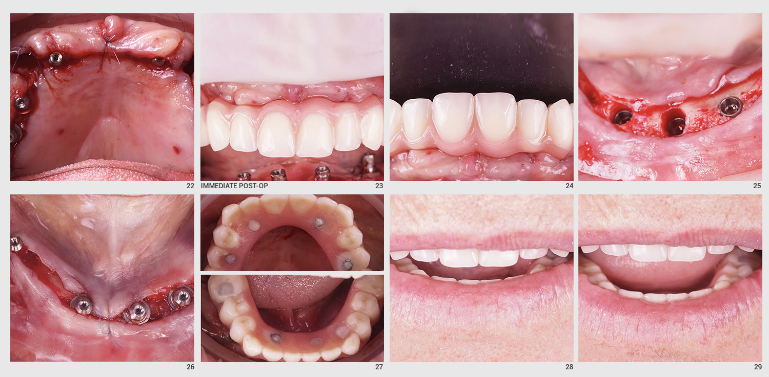 Full arch rehabilitation: Digital guided surgery for upper loading and ...