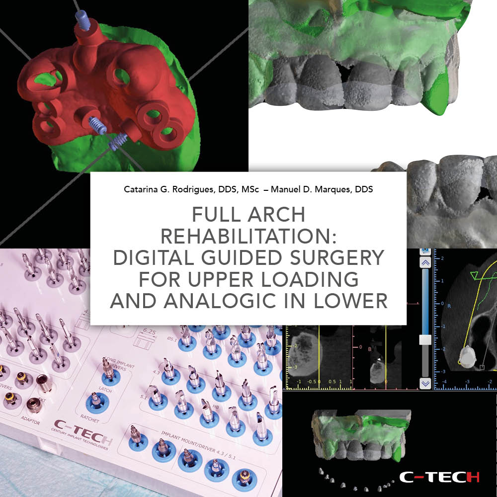 Full arch rehabilitation: Digital guided surgery for upper loading and ...