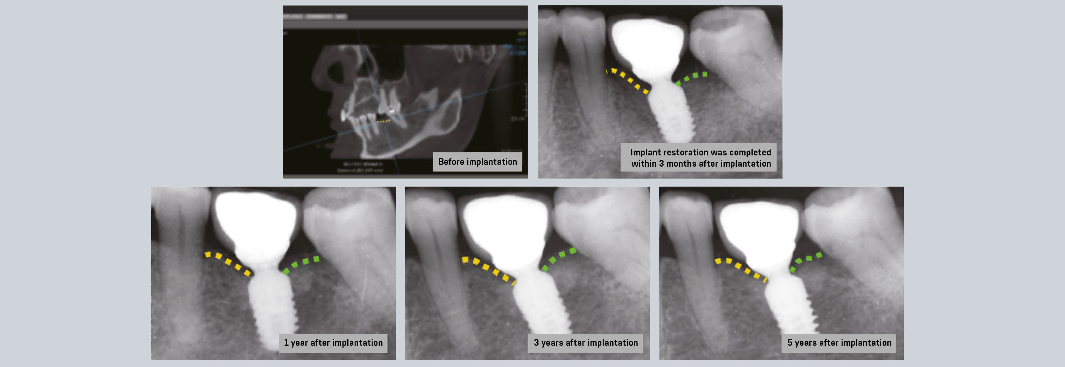Effect tracking of bone stability: Mandibular posterior area | C-Tech ...