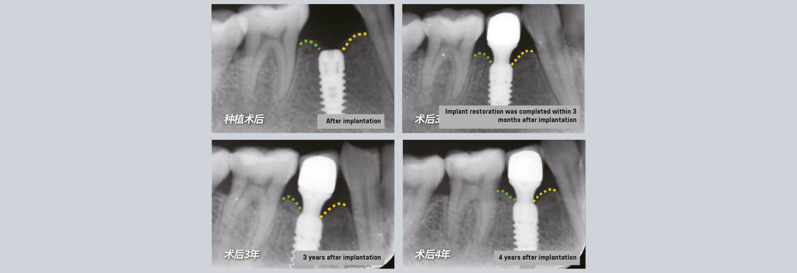 Effect tracking of bone stability: Mandibular posterior area | C-Tech ...