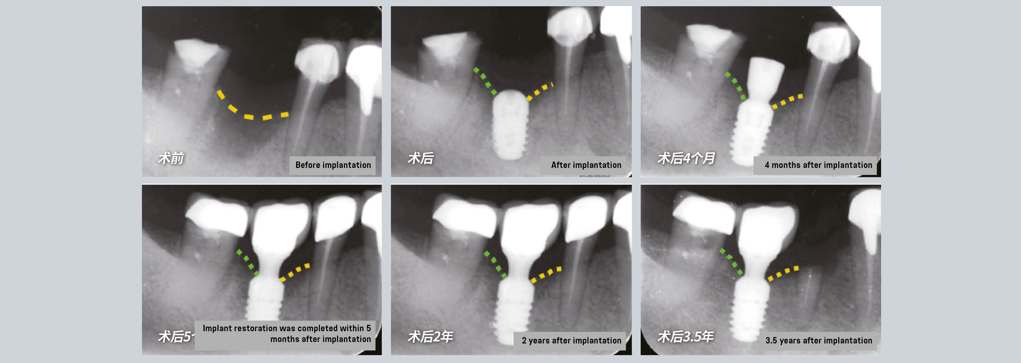 Effect tracking of bone stability: Mandibular posterior area | C-Tech ...