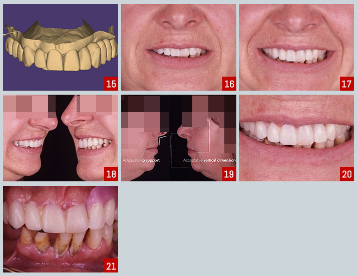 Full arch case: immediate implant placement with guided surgery and ...
