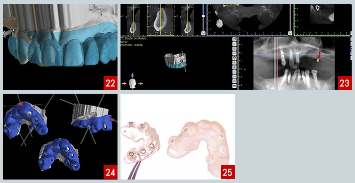 Full arch case: immediate implant placement with guided surgery and ...
