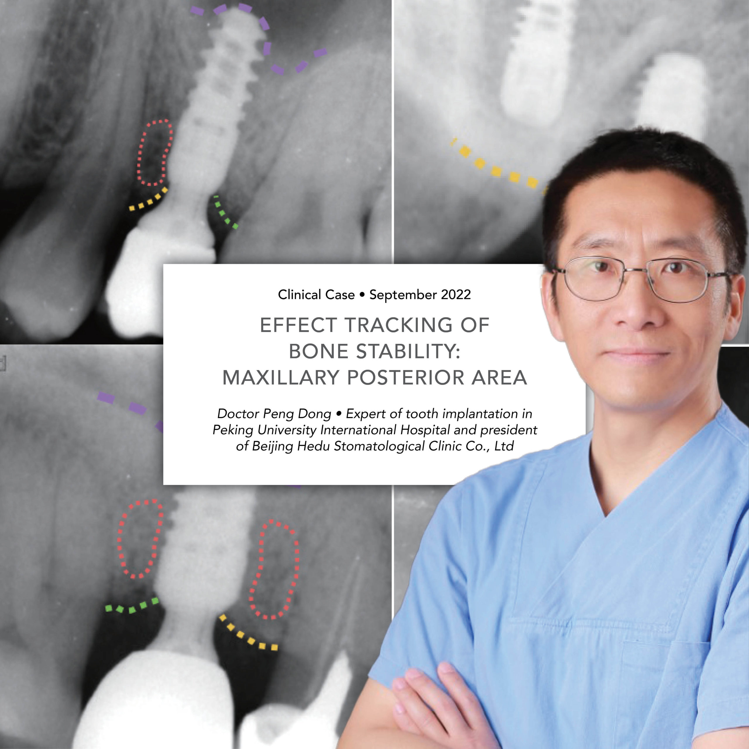 Effect tracking of bone stability: Maxillary posterior area | C-Tech ...