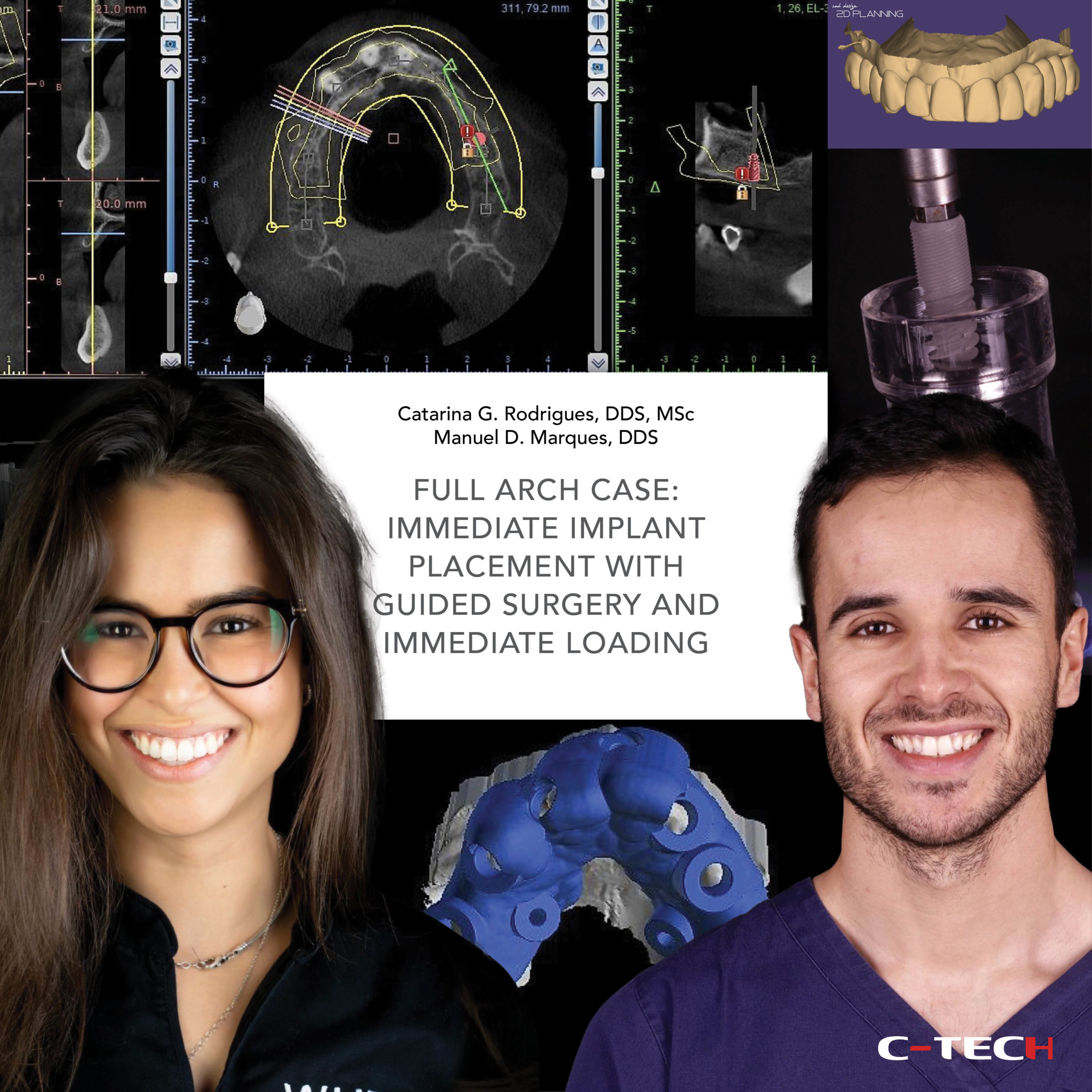 Full arch case: immediate implant placement with guided surgery and ...