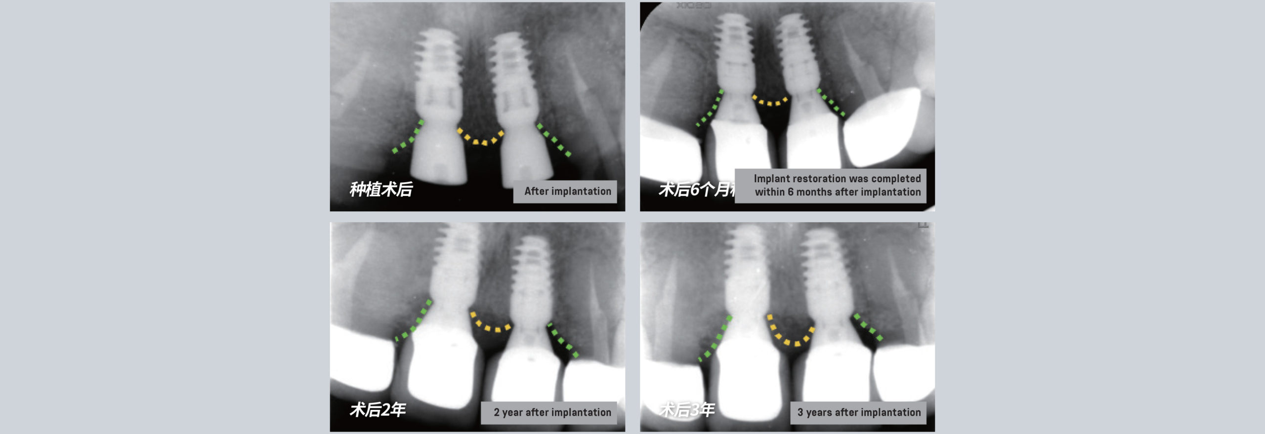 Effect tracking of bone stability: Anterior area | C-Tech Implant ...