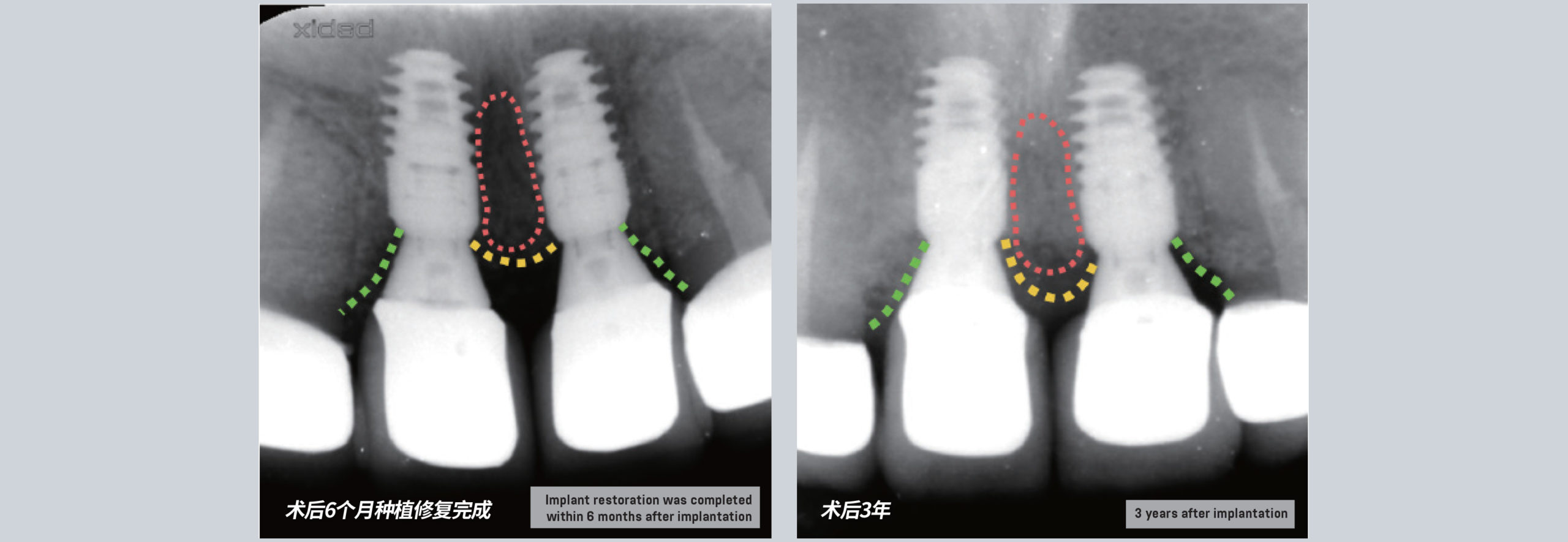 Effect tracking of bone stability: Anterior area | C-Tech Implant ...