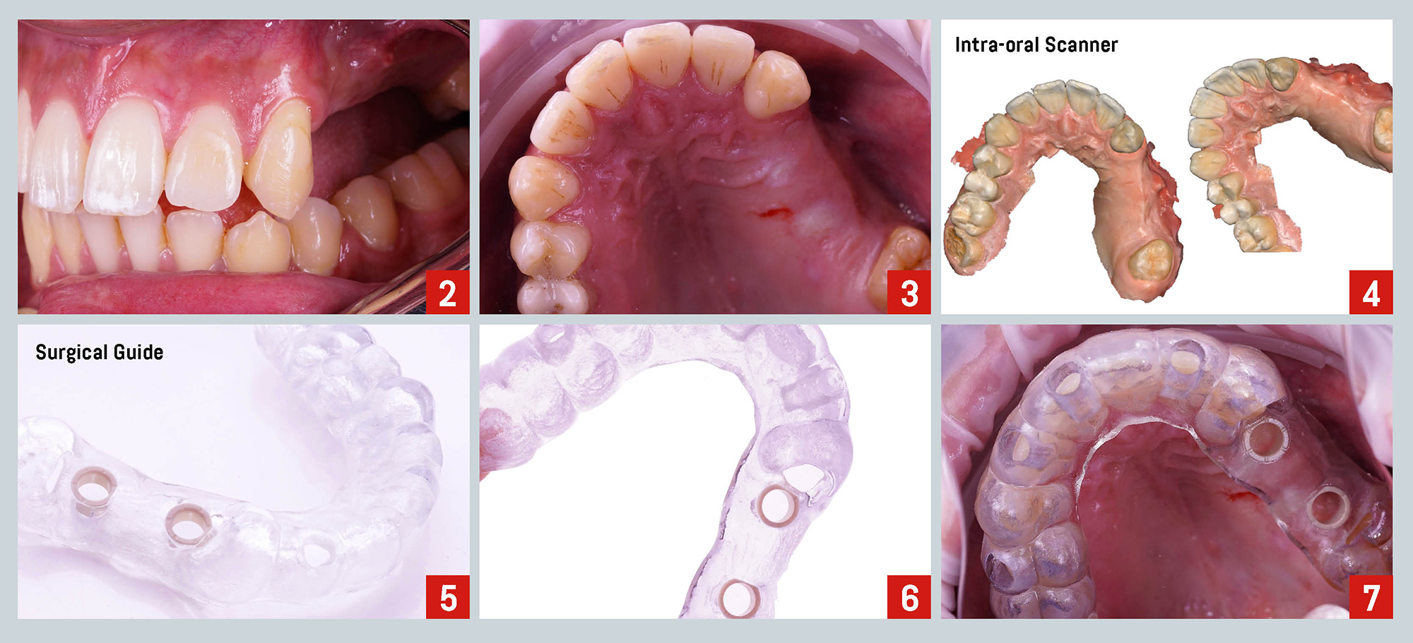 3-unit Bridge over Implants using Guided Surgery and One Time Concept ...