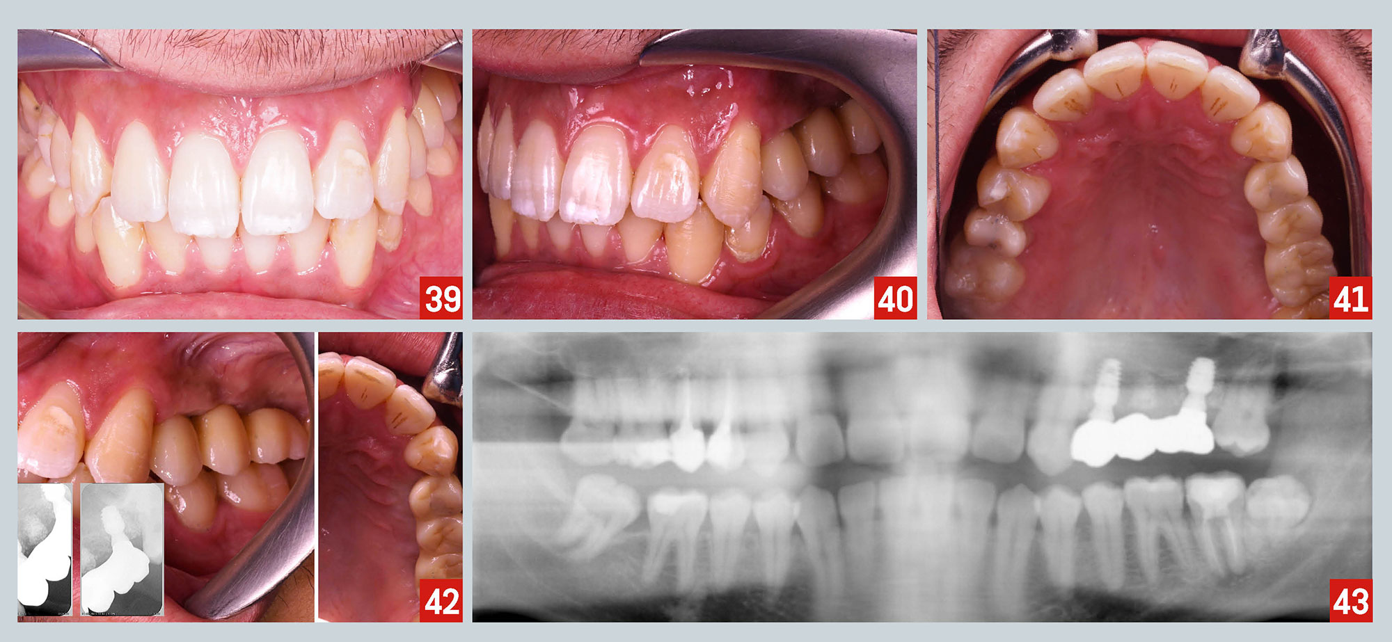 3-unit Bridge over Implants using Guided Surgery and One Time Concept ...