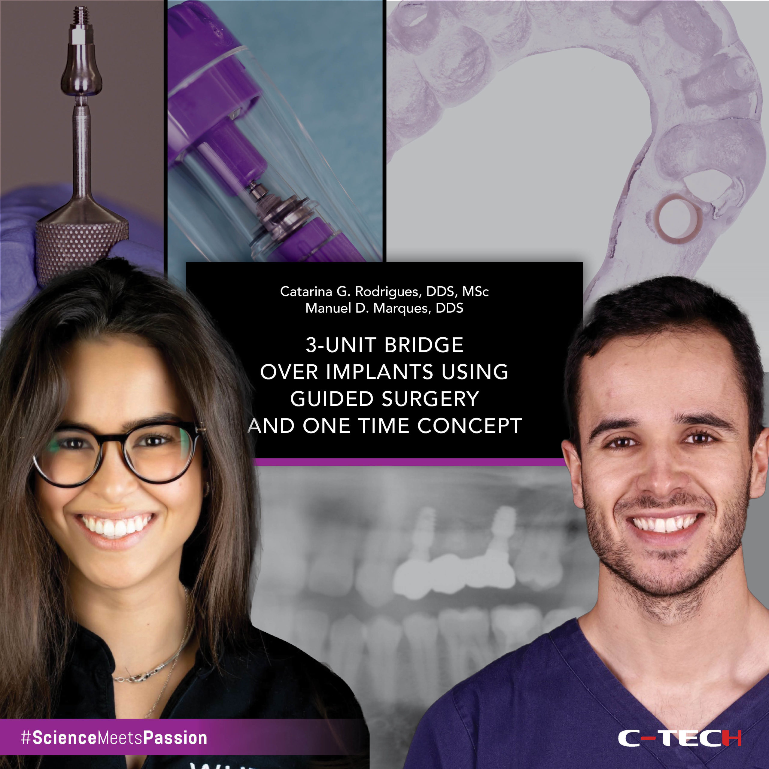 3-unit Bridge over Implants using Guided Surgery and One Time Concept ...