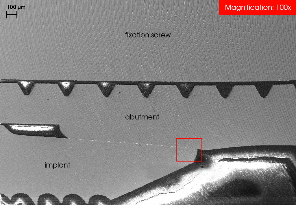 Mikro boşluğun azaltılması | C-Tech İmplant | Geleneksel diş implantları